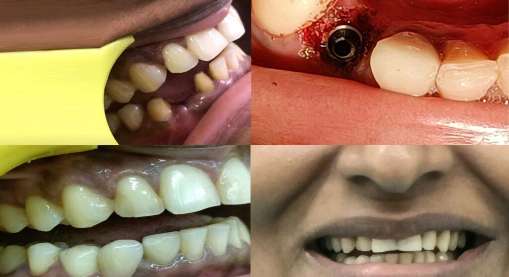 Single Tooth Implant - Mahimaa Dental Care