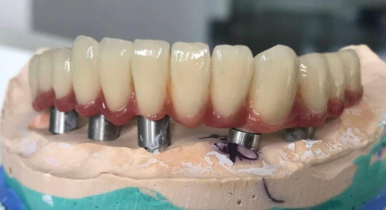 Multiple Teeth Implants - Mahimaa Dental Care